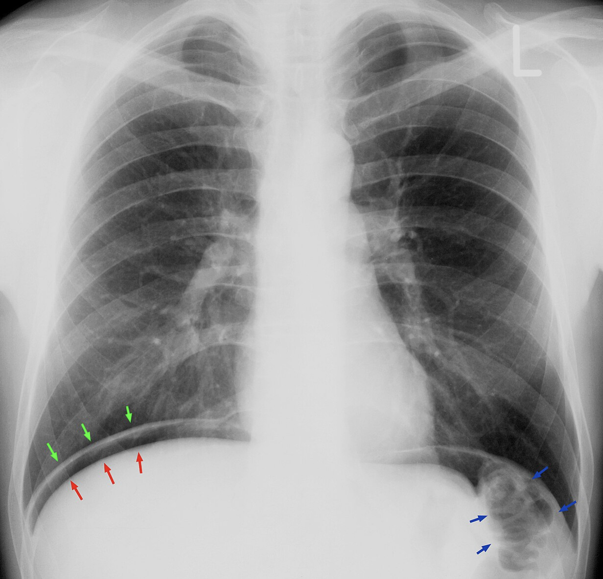 Diagnostics and Therapeutics: Caustic Ingestions in the Emergency Department — Taming the SRU